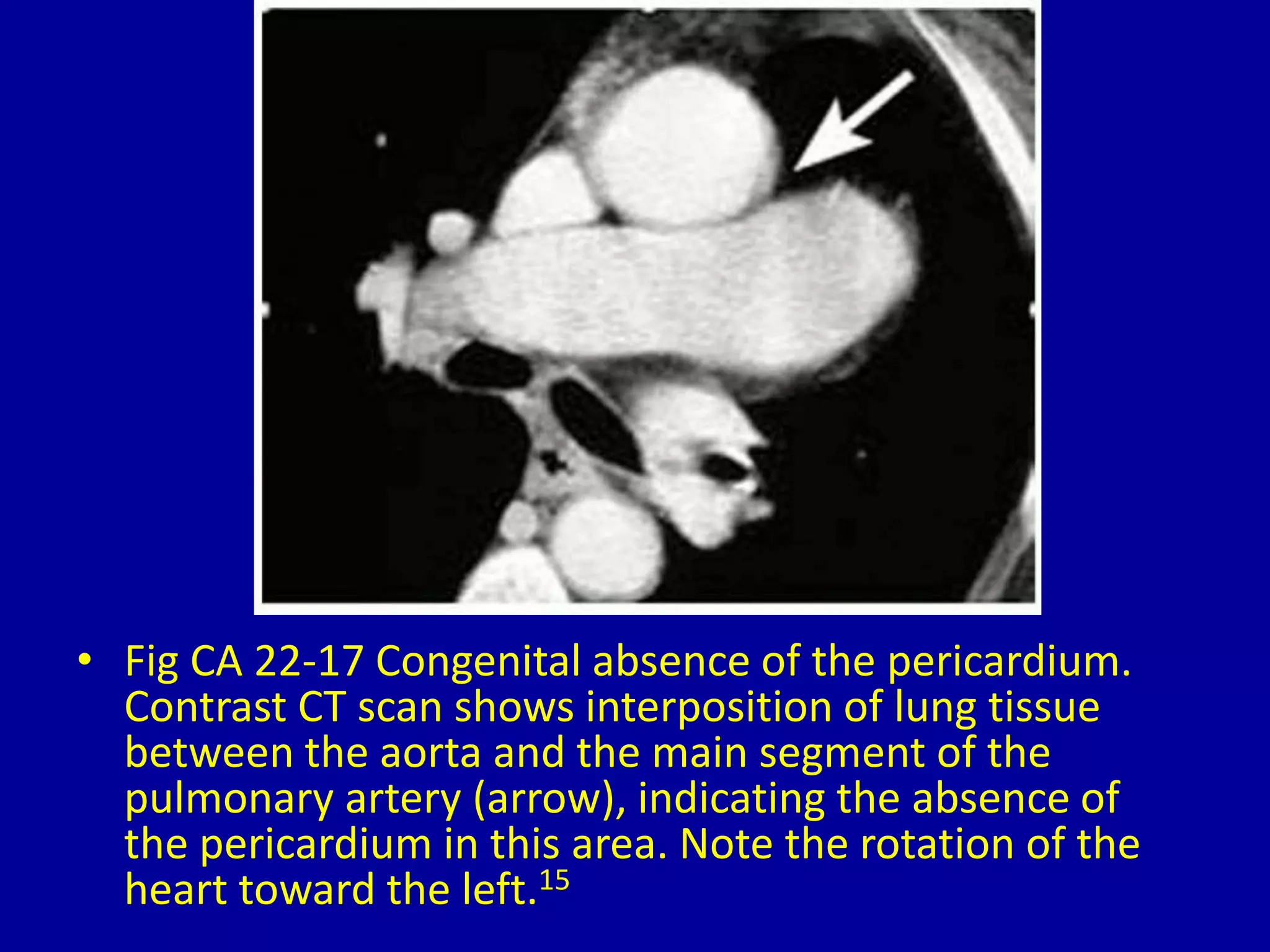 22 pericardial disease on computed tomography and magnetic | PPTX