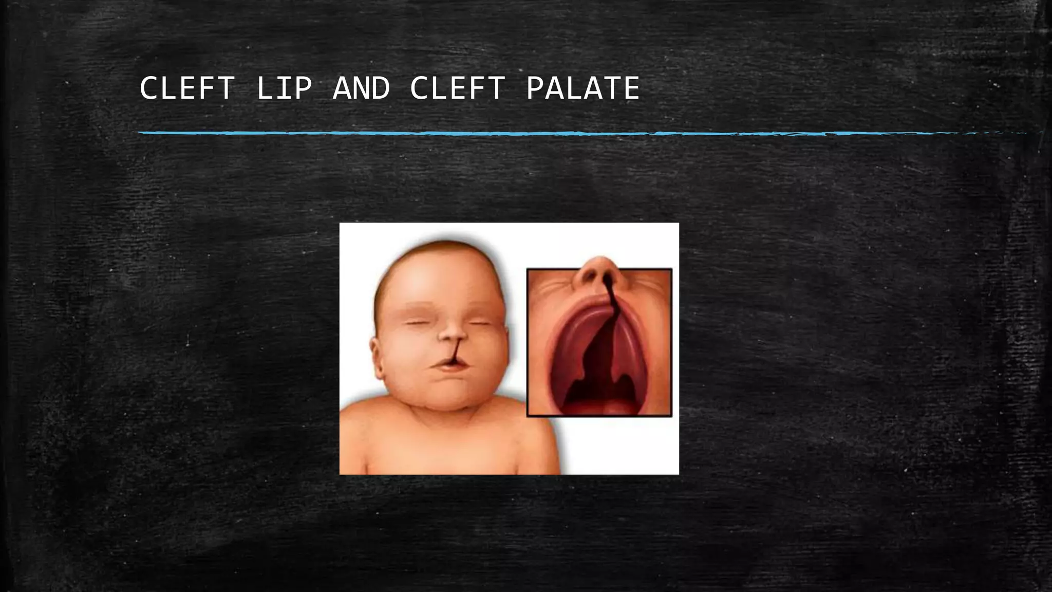 Digeorge syndrome | PPTX