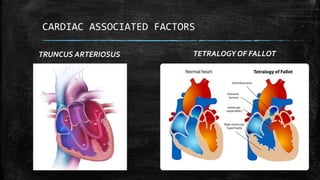 Digeorge syndrome | PPTX