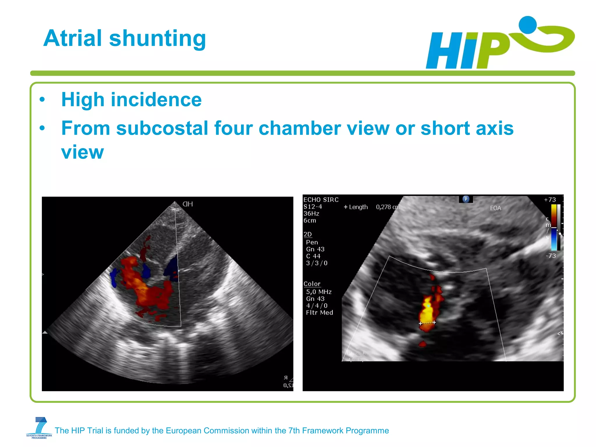 Functional Echocardiography. Targeted neonatal echocardiography (TNE). Point of care ...