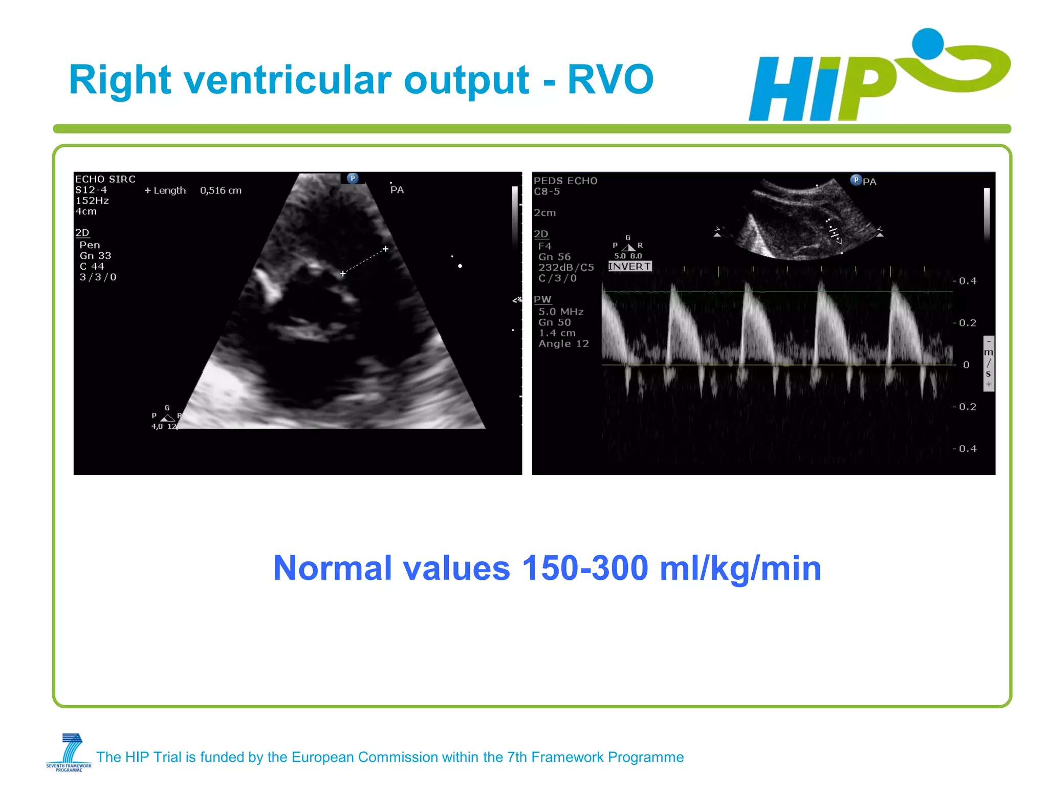 Functional Echocardiography. Targeted neonatal echocardiography (TNE). Point of care ...
