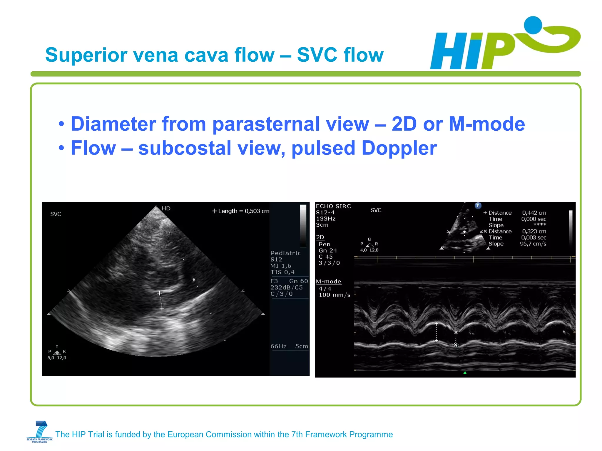 Functional Echocardiography. Targeted neonatal echocardiography (TNE). Point of care ...