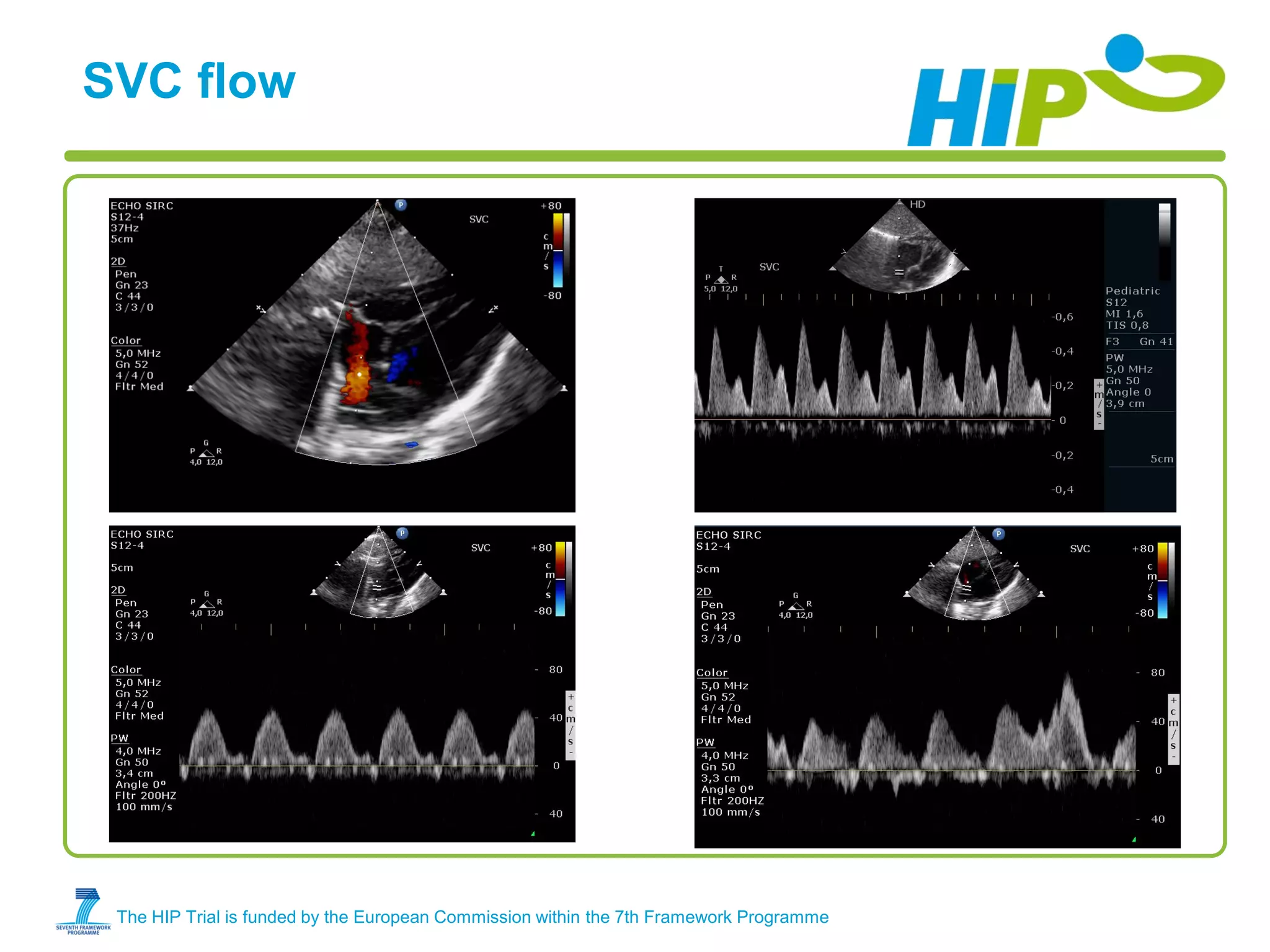 Functional Echocardiography. Targeted neonatal echocardiography (TNE ...