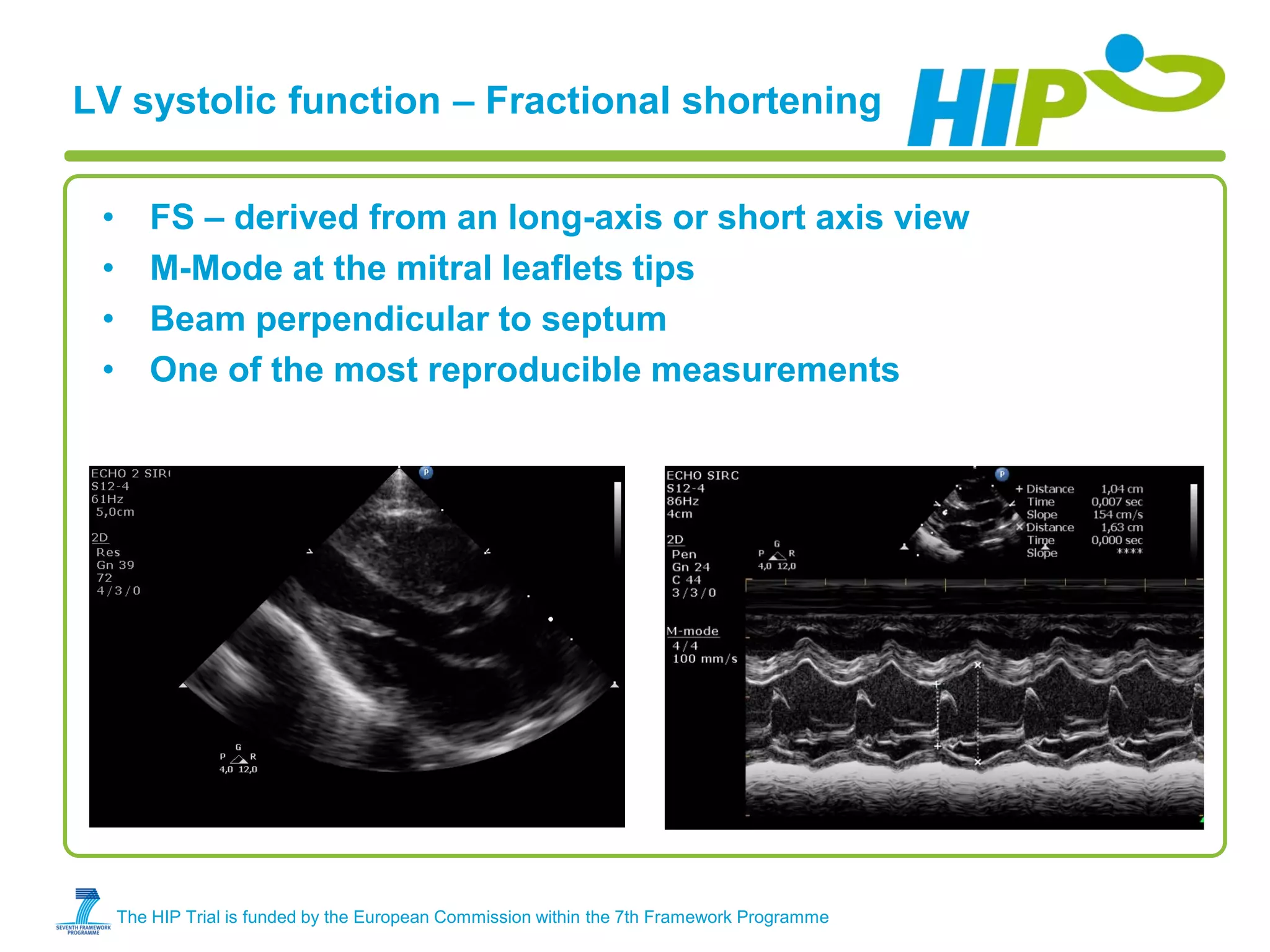 Functional Echocardiography. Targeted neonatal echocardiography (TNE). Point of care ...