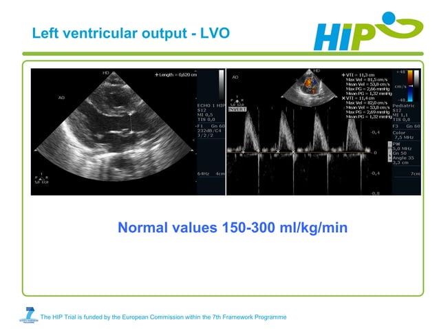 Functional Echocardiography. Targeted neonatal echocardiography (TNE). Point of care ...