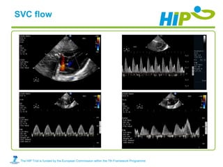 Functional Echocardiography. Targeted neonatal echocardiography (TNE ...