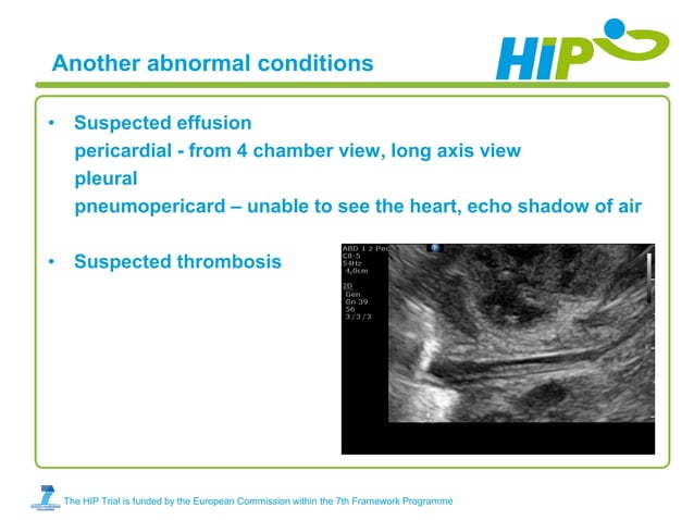Functional Echocardiography. Targeted neonatal echocardiography (TNE). Point of care ...