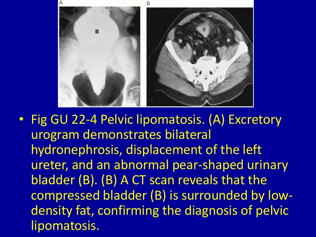 22 small urinary bladder