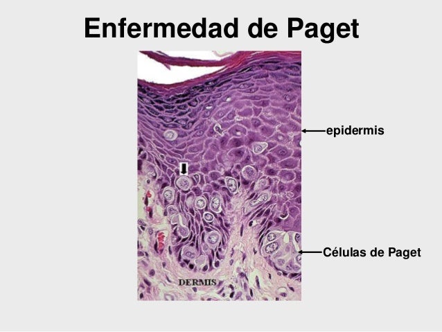 Enfermedad De Paget Del Pezon