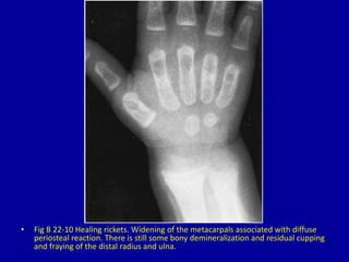 22 underconstriction or undertubulation (wide diametaphysis) | PPTX ...
