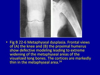 22 underconstriction or undertubulation (wide diametaphysis) | PPTX
