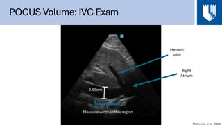 Reviving the Physical Exam: The POCUS Volume Assessment | PDF