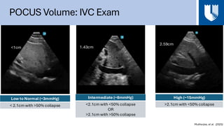 Reviving the Physical Exam: The POCUS Volume Assessment | PDF