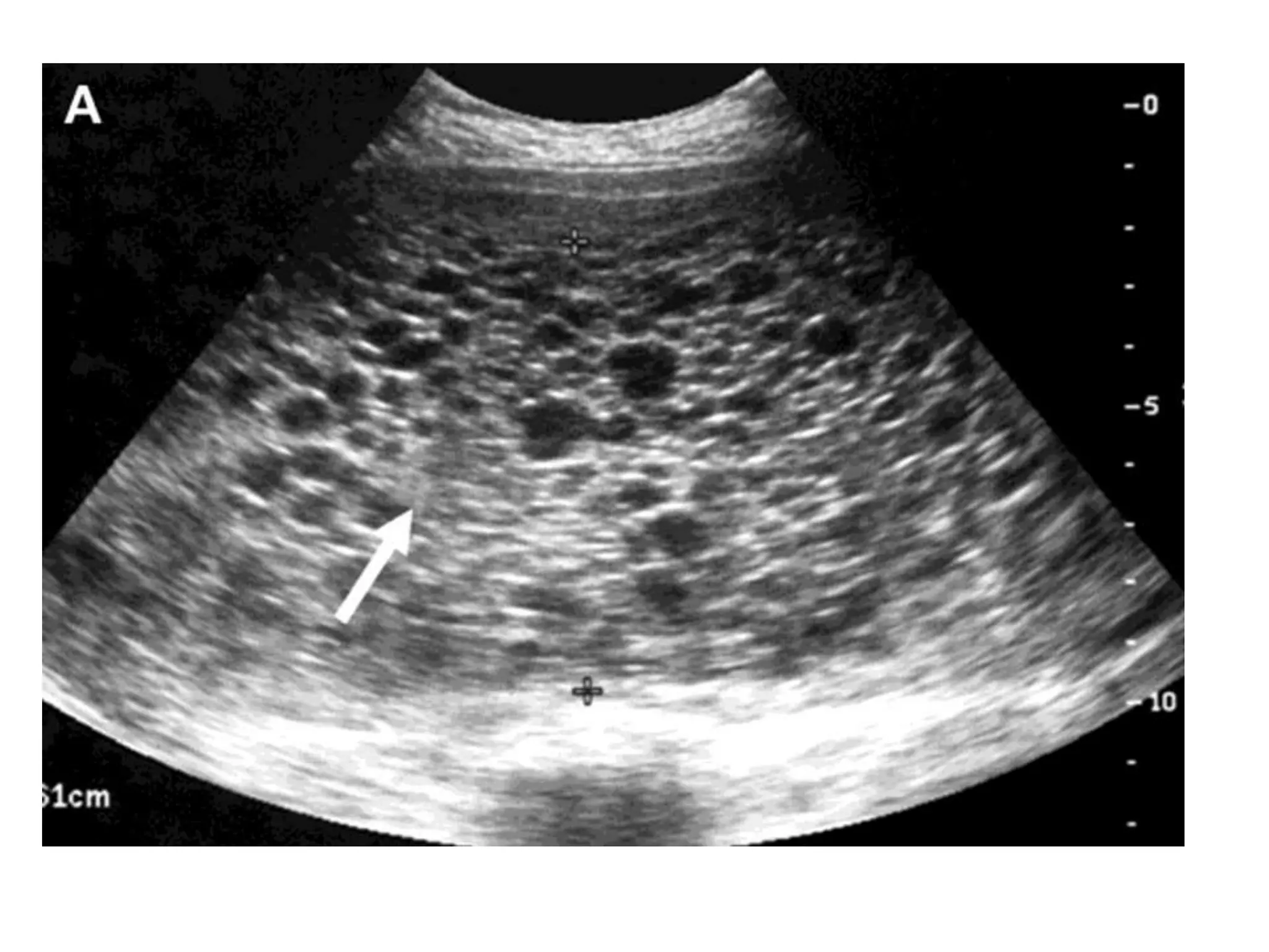 23. gestational trophoblastic diseases | PPTX