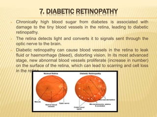 diabetic retinopathy | PPT