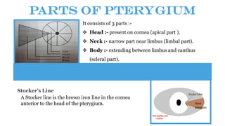 Pterygium (Arma) | PDF