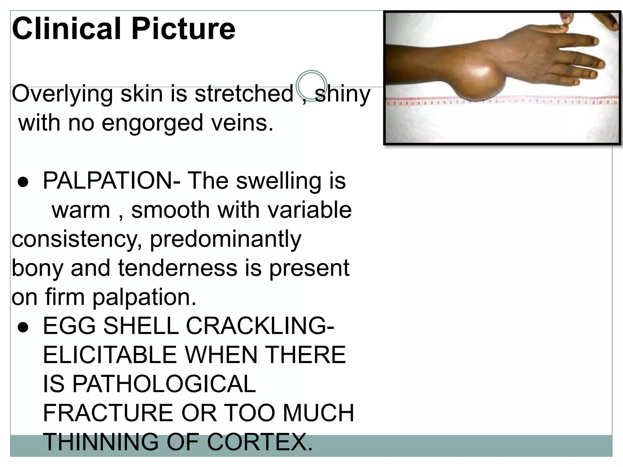 Giant Cell Tumour | PPTX