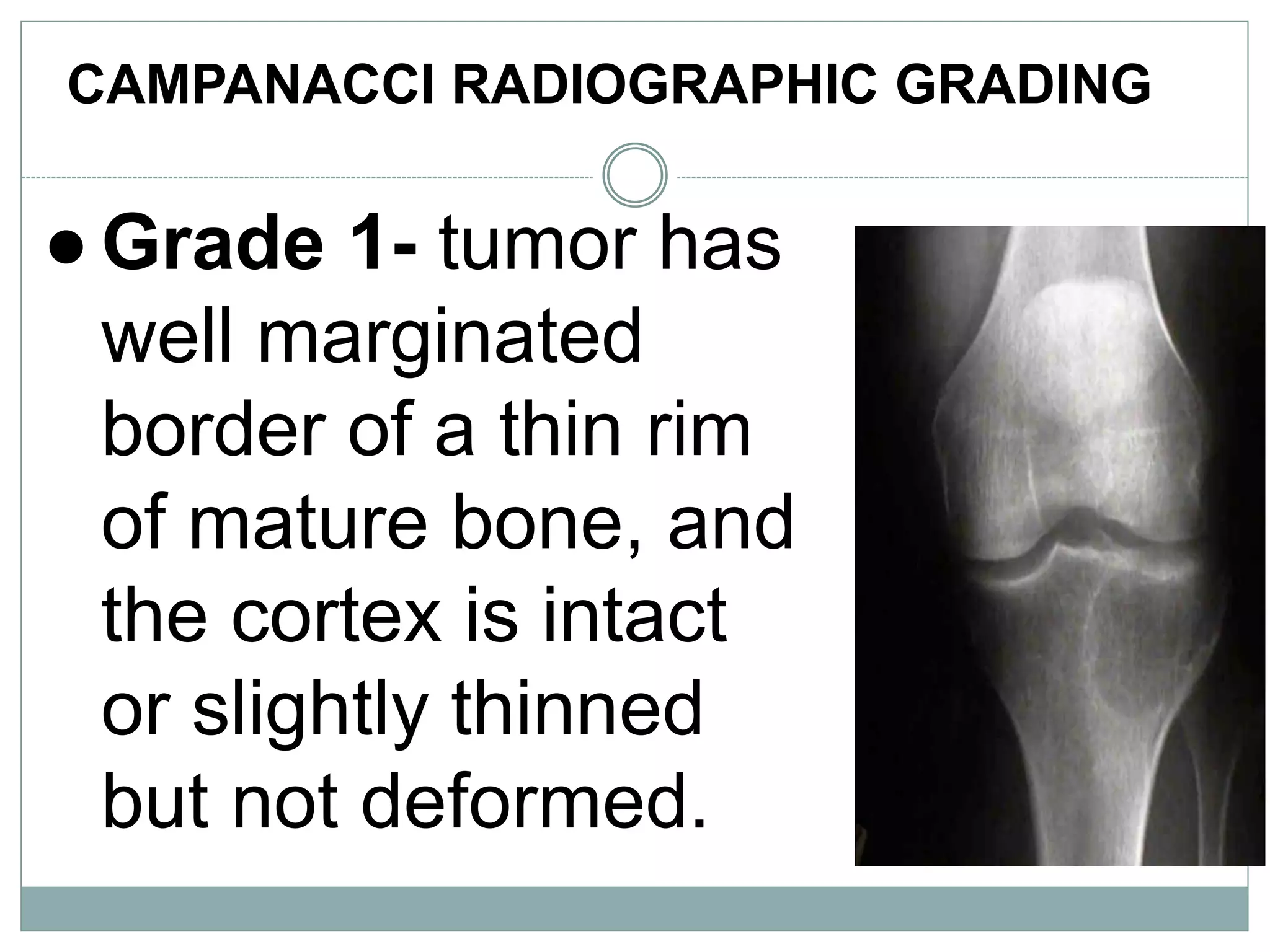 Giant Cell Tumour | PPTX