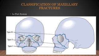 Mandibular and Maxillary Fractures | PPTX