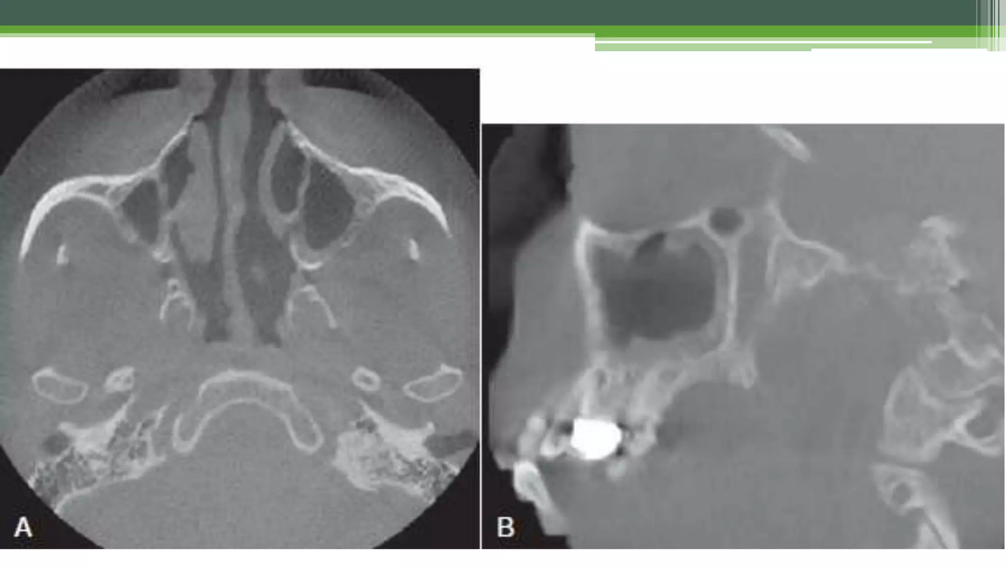 Radiographic Features of Paranasal Sinuses | PPTX