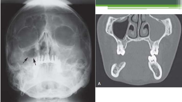 Radiographic Features of Paranasal Sinuses | PPTX | Ear, Nose and ...