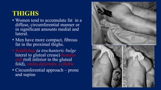 Liposuction | PPTX