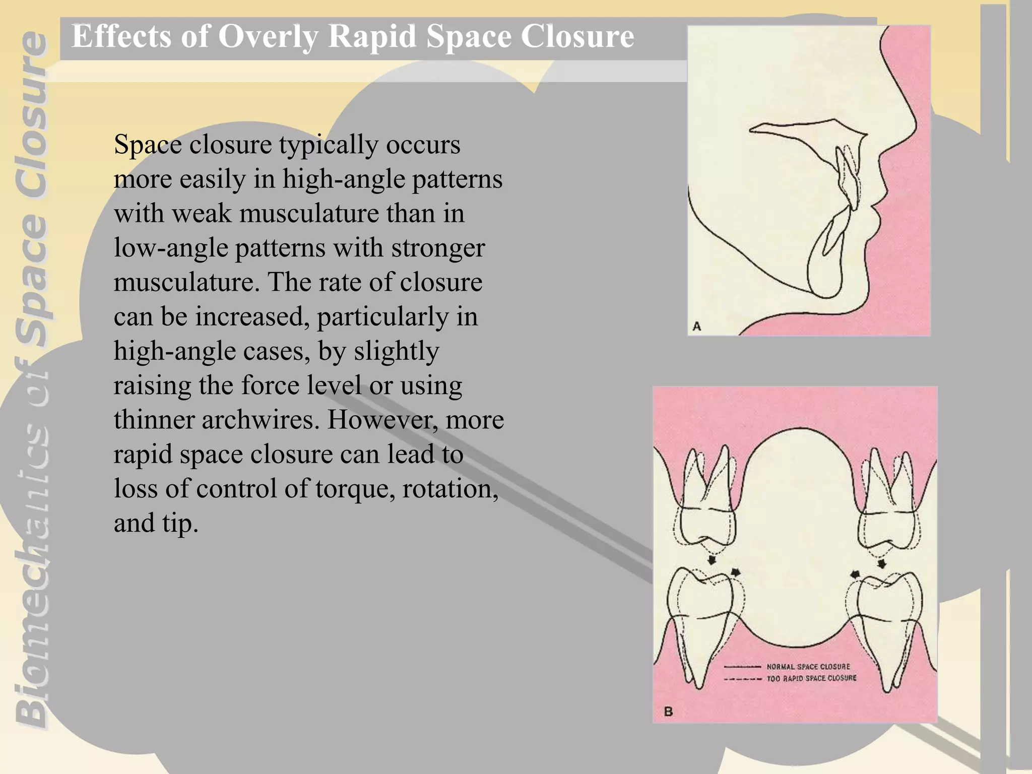 Biomechanics of Space Closure | PPT