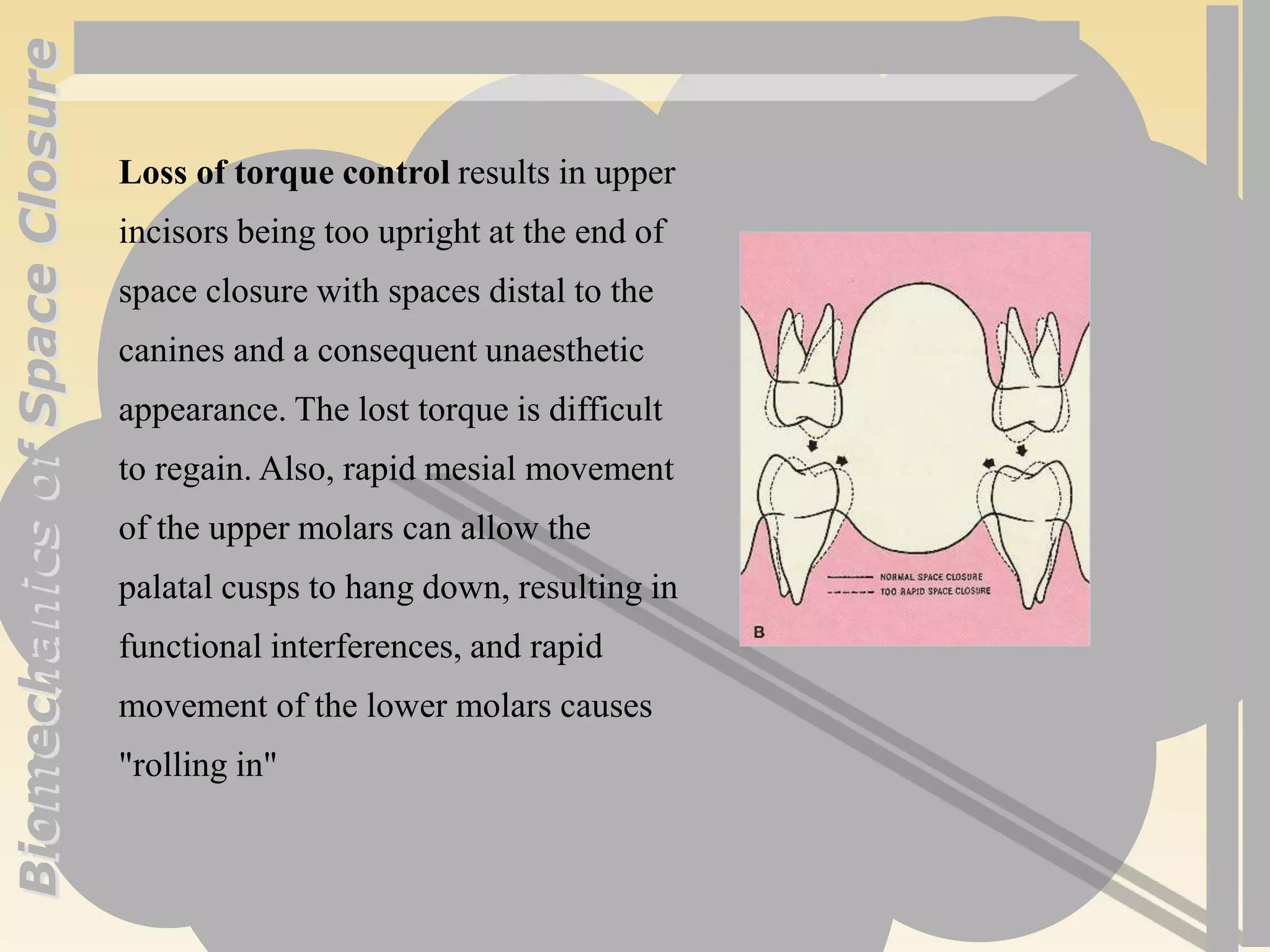 Biomechanics of Space Closure | PPT