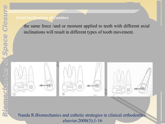 Biomechanics of Space Closure | PPT