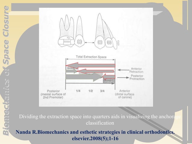 Biomechanics of Space Closure | PPT