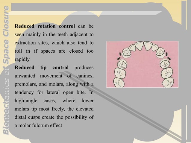 Biomechanics of Space Closure | PPT