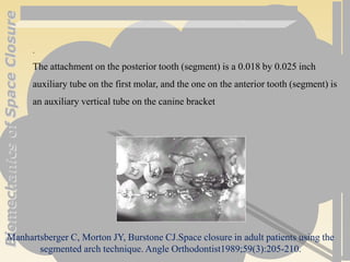 Biomechanics of Space Closure | PPT