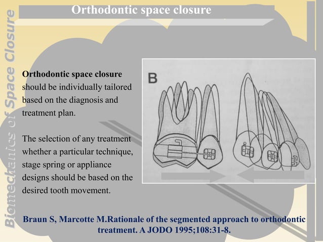 Biomechanics of Space Closure | PPT