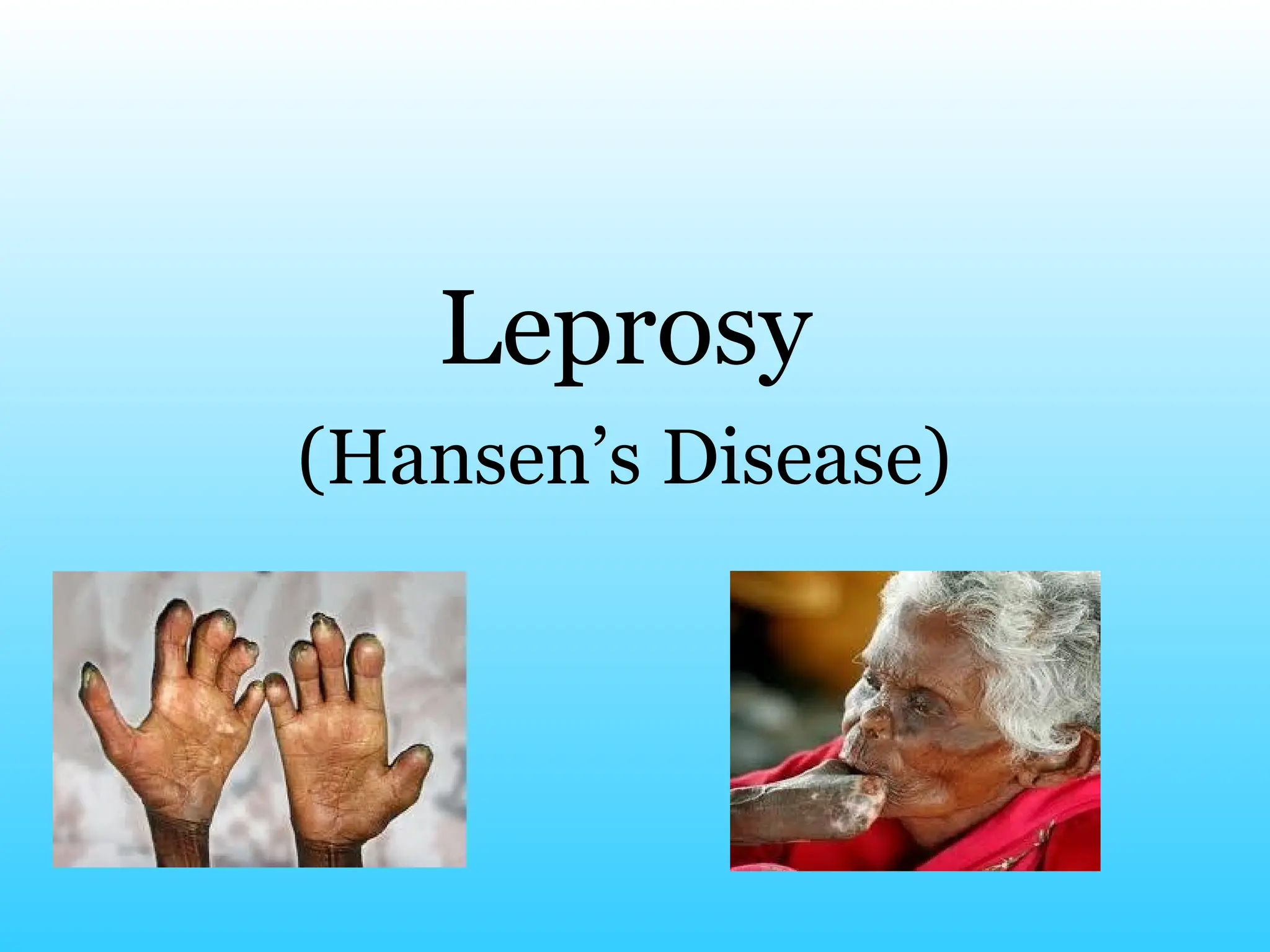 LEPROSY pathophysiology hansen's disease | PPTX