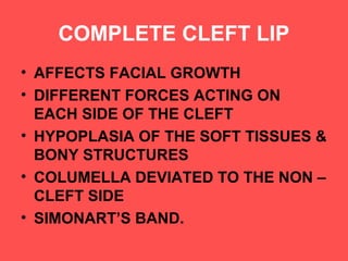 23 introduction cleft lip & palate | PPT