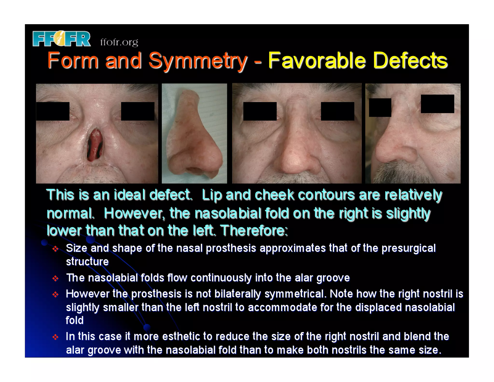 23.restoration of nasal defects | PDF