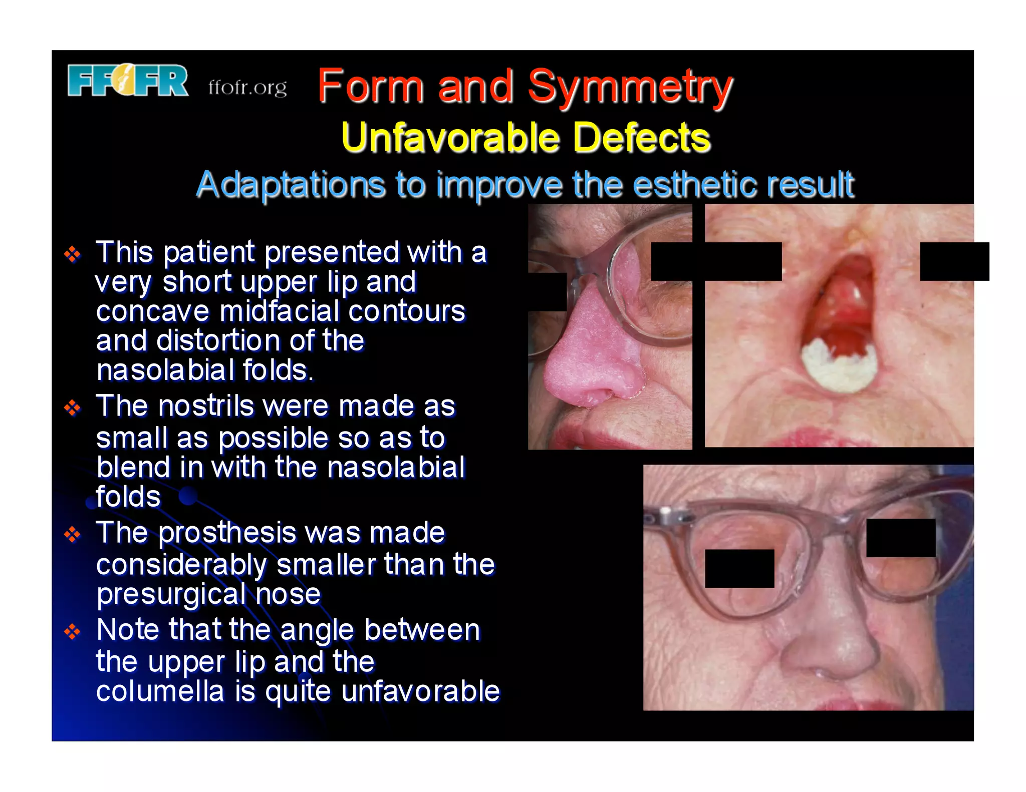 23.restoration of nasal defects | PDF