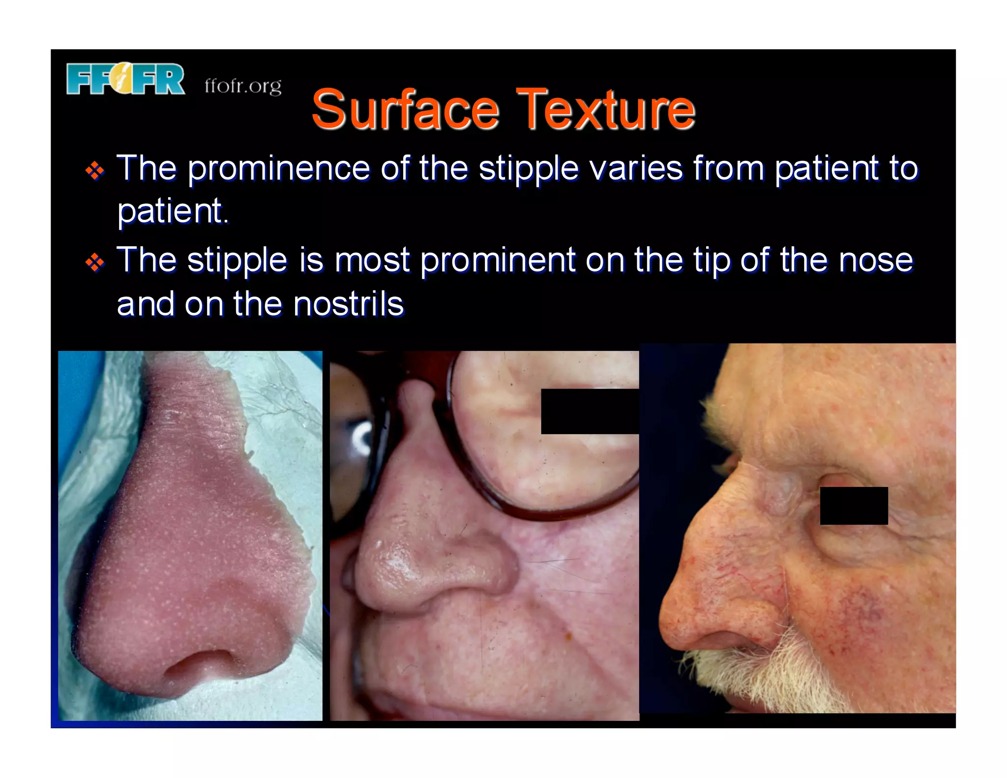 23.restoration of nasal defects | PDF