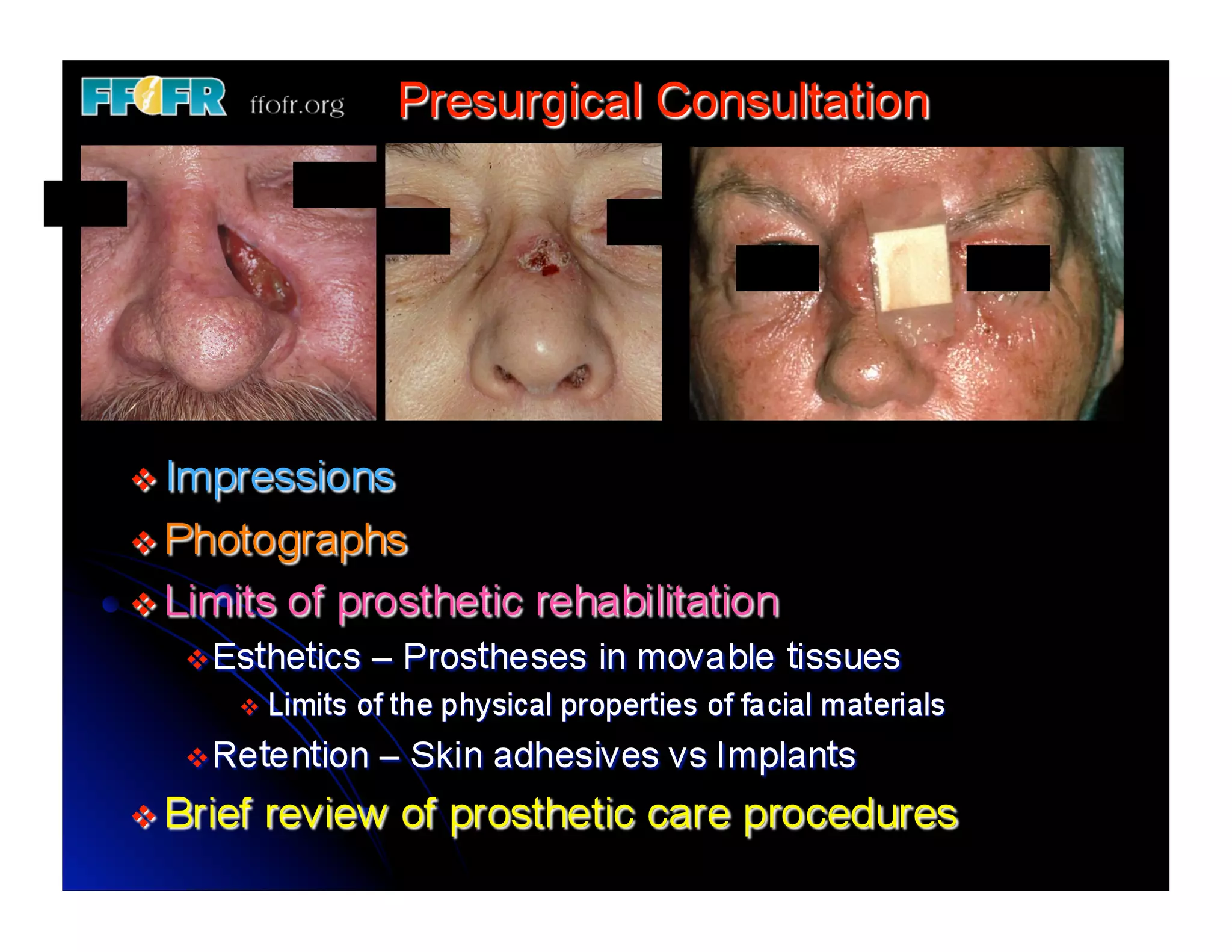 23.restoration of nasal defects | PDF