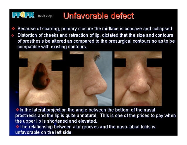23.restoration of nasal defects | PDF
