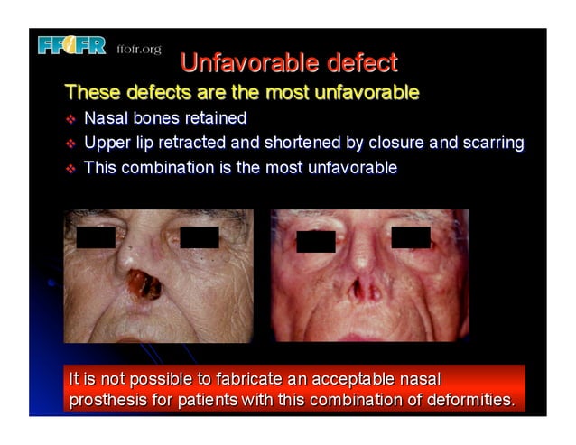 23.restoration of nasal defects | PDF
