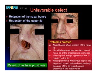 23.restoration of nasal defects | PDF