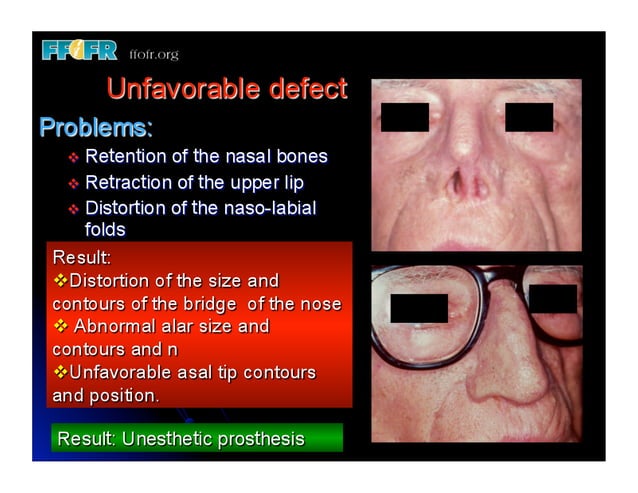 23.restoration of nasal defects | PDF