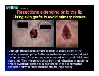 23.restoration of nasal defects | PDF