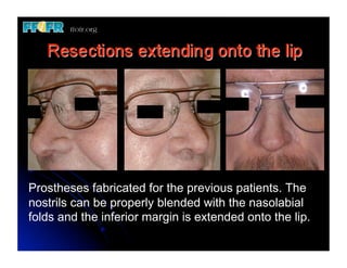 23.restoration of nasal defects | PDF