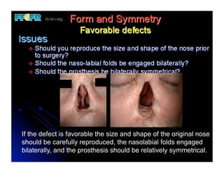 23.restoration of nasal defects | PDF