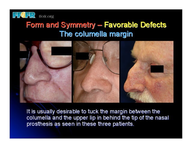 23.restoration of nasal defects | PDF