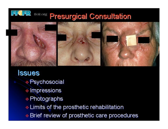 23.restoration of nasal defects | PDF