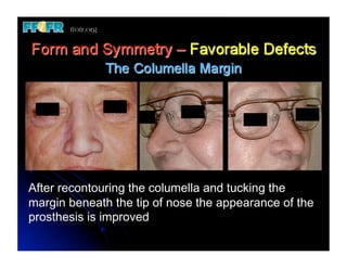 23.restoration of nasal defects | PDF