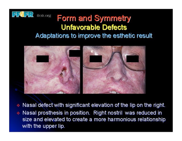 23.restoration of nasal defects | PDF
